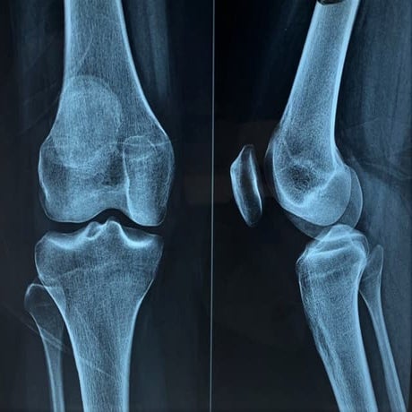 Knee lateral view | PPT