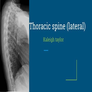 Lateral t spine kaleigh | PPTX