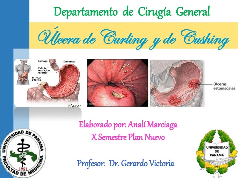 Úlcera de Curling y de Cushing