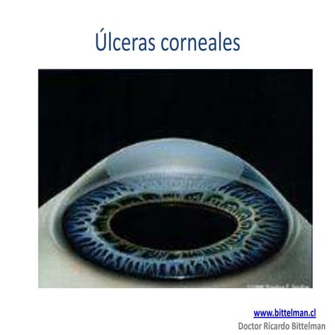 úLceras corneales | PPTX