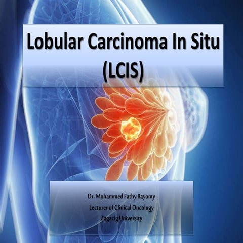 Lobular Carcinoma In Situ (LCIS) | PPTX