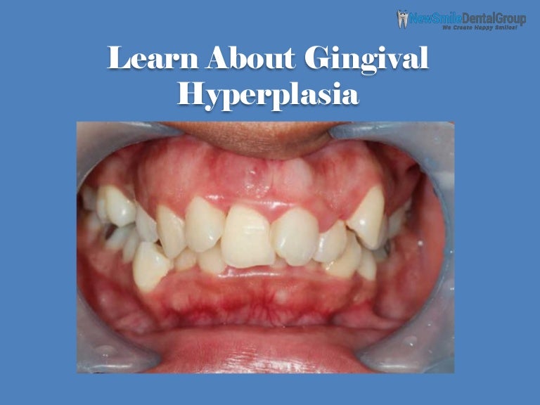 Learn About Gingival Hyperplasia