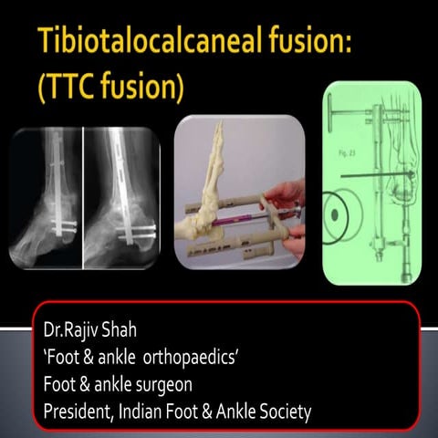 Lecture 37 shah ttc fusion | PPTX