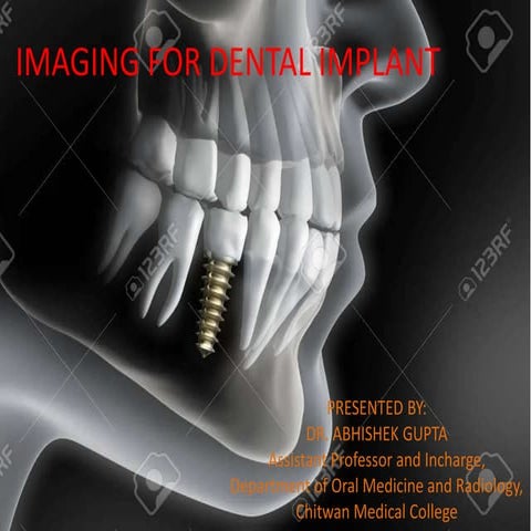 RADIOGRAPHS FOR DENTAL IMPLANT.pptx