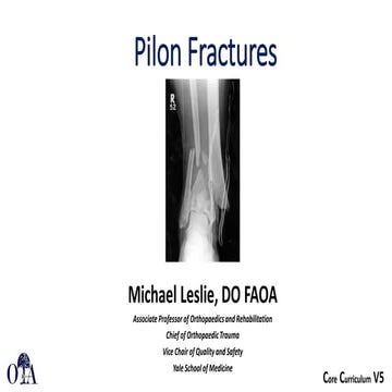 Pilon Fractures definition and classification | PDF
