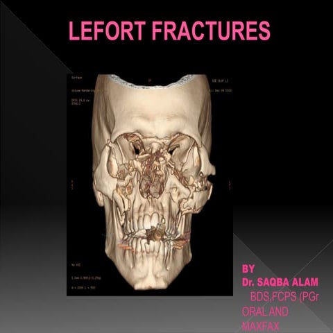 Lefort fractures | PPT