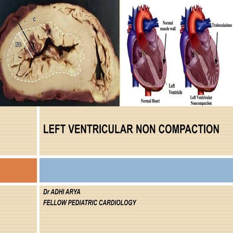 Left ventricular non compaction | PPT