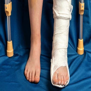 Leg fracture with a cast. | PDF