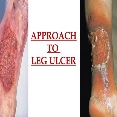 legulcer all types of leg ulcers and treatment.pptx