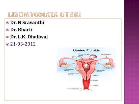 Endometriosis- Easy explanation with Management... | PDF