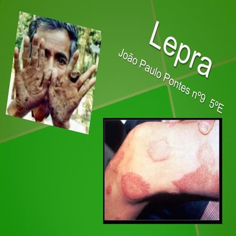 Lepra 5 e9joãopaulo | PPTX