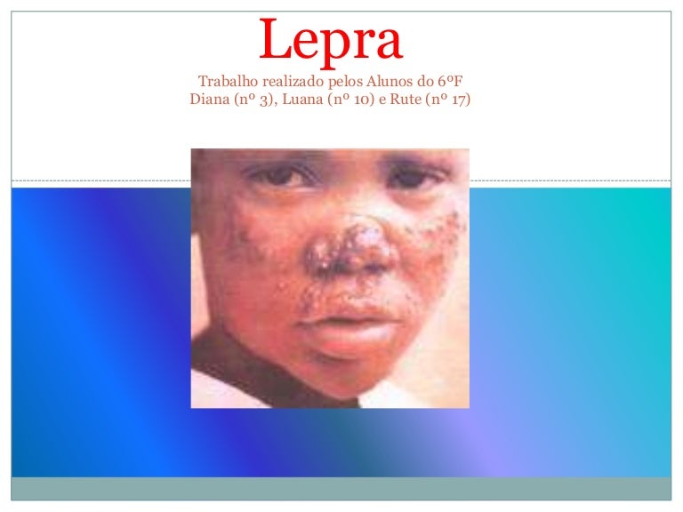 Lepra