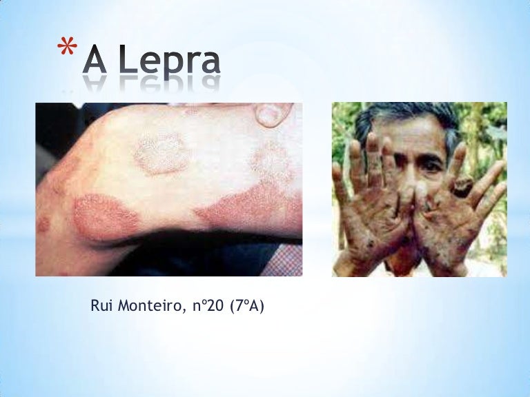 Lepra