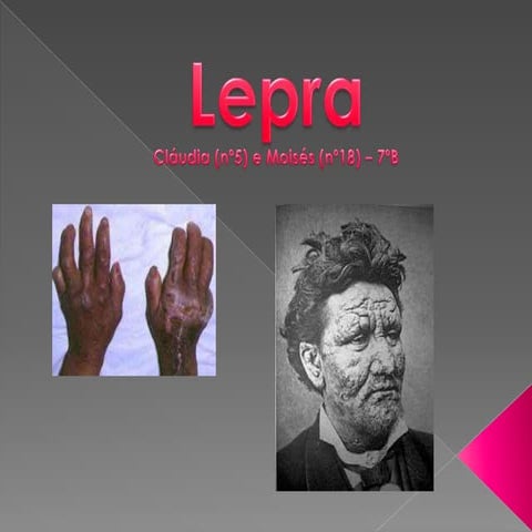 Lepra | PPT