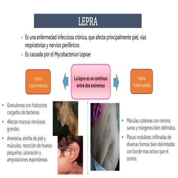Lepra lepromatosa tuberculoideejjj.pptx