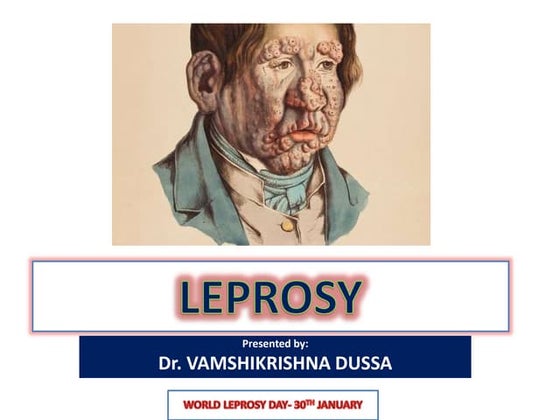 LEPROSY (Hansen disease) types, clinical features.pptx