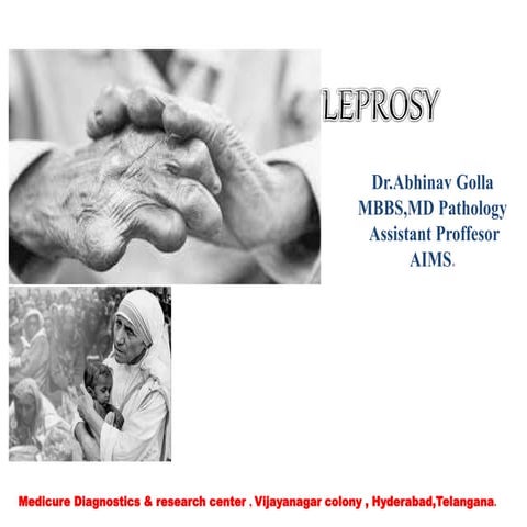 Leprosy | PPT