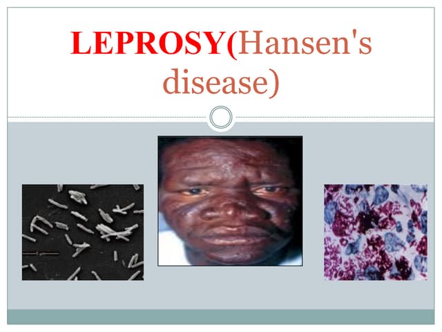 Leprosy | PPT