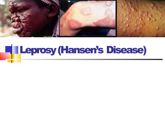Leprosy | PPT | Infectious Diseases | Diseases and Conditions