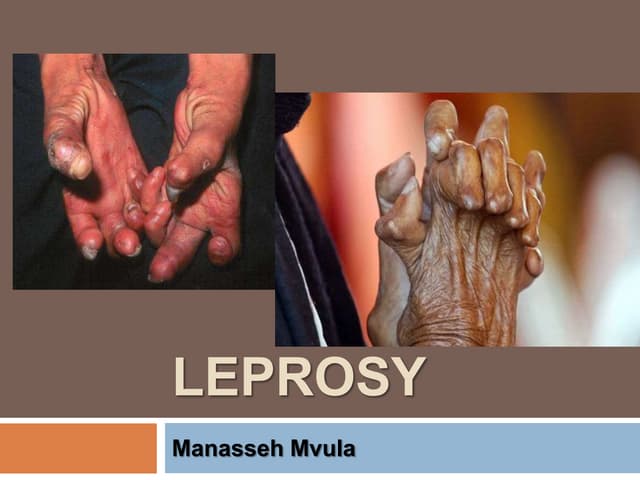 Leprosy | PPT | Infectious Diseases | Diseases and Conditions