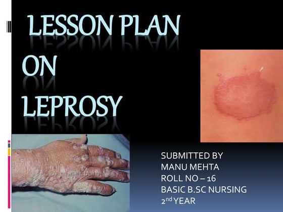 Leprosy Disease PPT (2).pdf topic about the leprosy disease | PDF | Skin and Dermatology ...