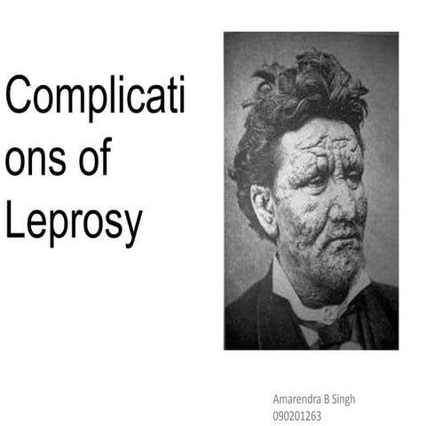 Complications of leprosy | PPTX