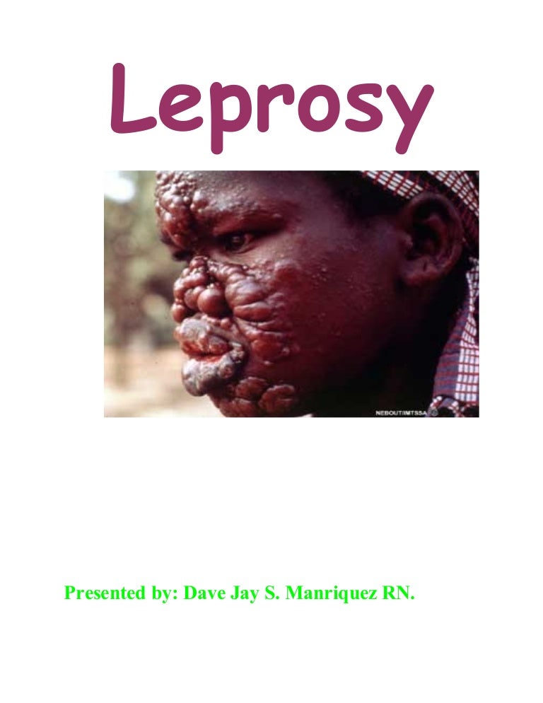 Leprosy