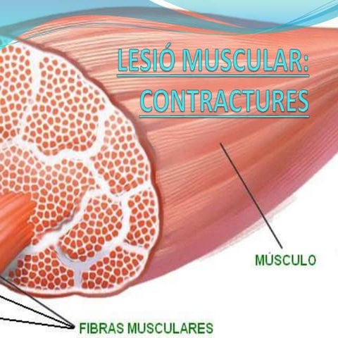 Lesió muscular:contractures_marc_mesas | PPT
