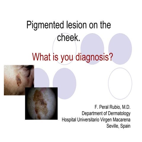 Clinical Case. Pigmented lesion on the cheek | PPT