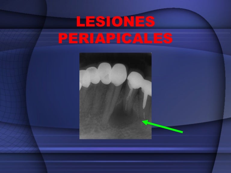 Lesiones periapicales