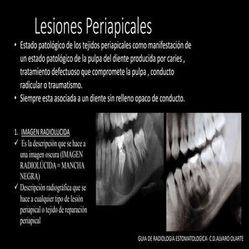Lesiones Periapicales.pptx