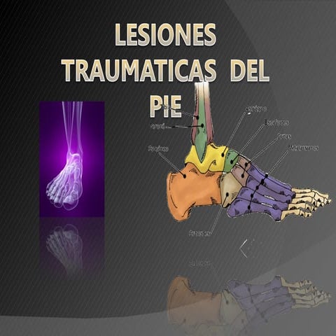 Lesiones traumaticas de pie ..... | PPT
