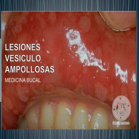 LESIONES VESICULO AMPOLLOSAS (3).pptx