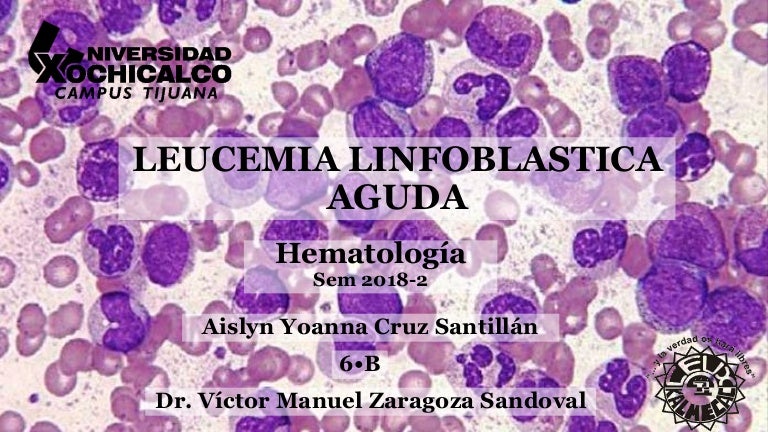 Leucemia linfoblastica aguda