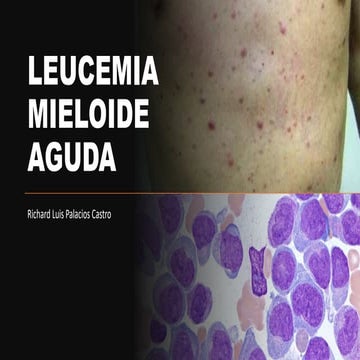 LEUCEMIA MIELOIDE AGUDA.pptx