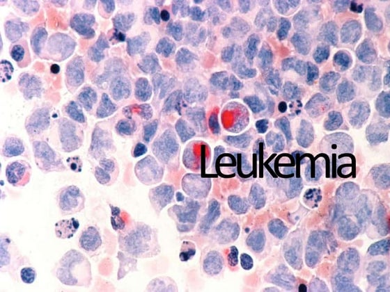 Leukemia | PPT
