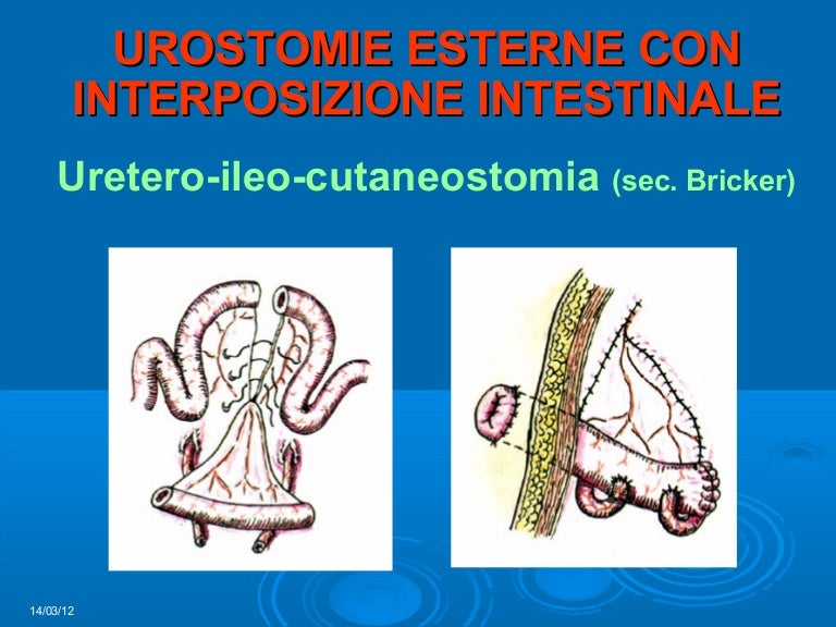 Le urostomie: seconda parte