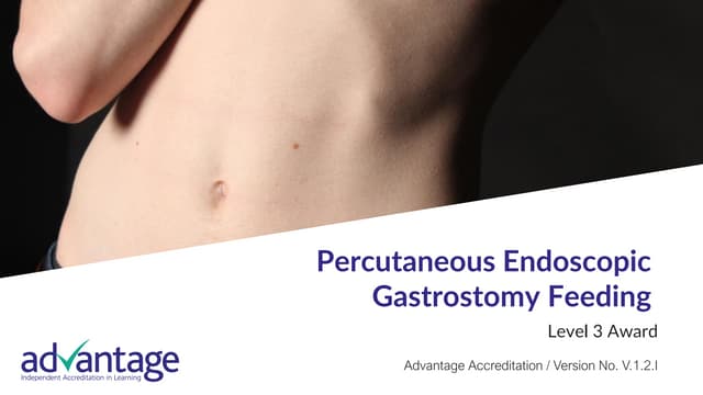 Tube feeding ( Gavage feeding ) | PPTX