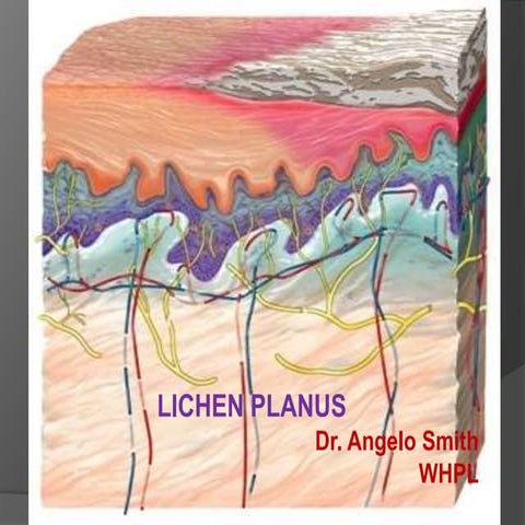 Lichen planus | PPTX