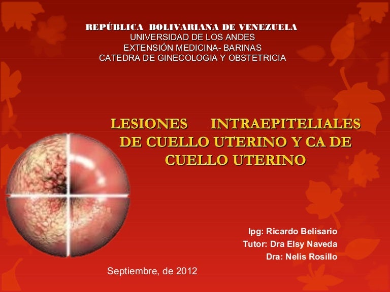 Cncer De Cuello Uterino Causas Y Sntomas Que Debes