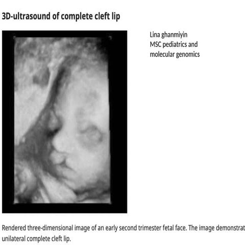 palate child cleft kjnfdcdolcnskn xslnda | PPT