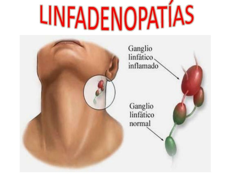 Linfadenopatías