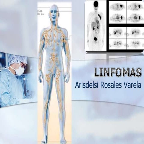 Linfomas | PPTX