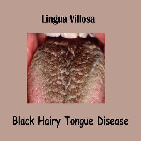 Lingua villosa nigra