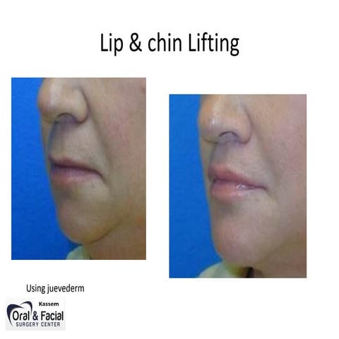 Lip & chin | PPT