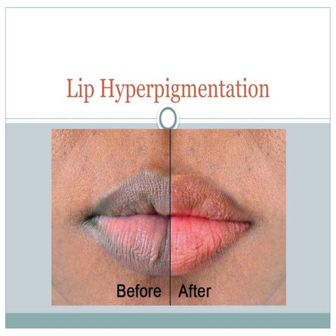 Lip Hyperpigmentation.pptx defines anatomy causes | PPT