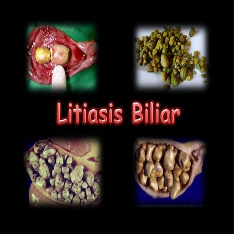 Litiasis | PPT