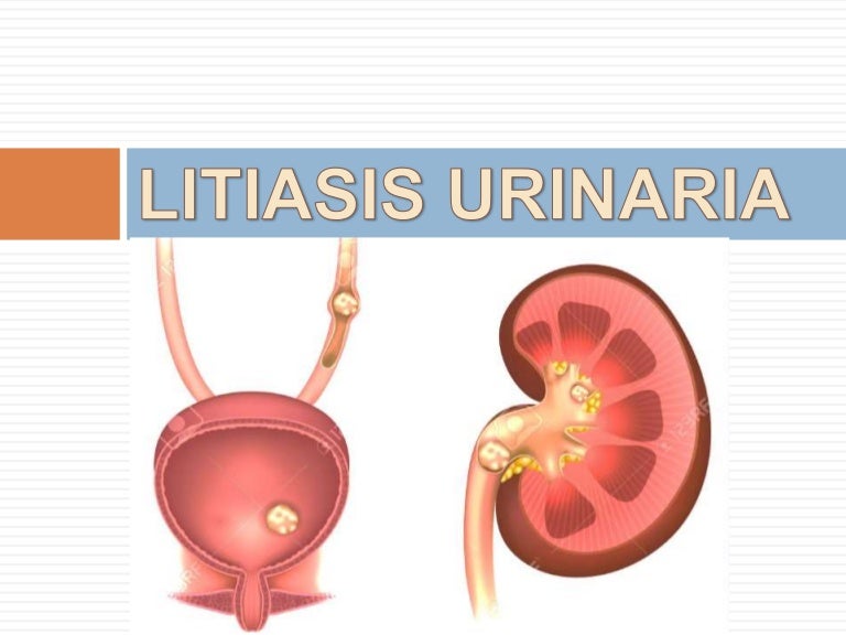 Litiasis urinaria