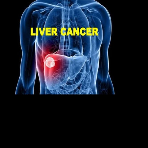 liver cancer nursing medical surgical nursing | PPTX