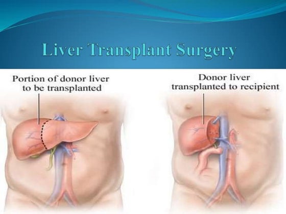 Liver Transplant Surgery_ Preparation and Procedure.pdf